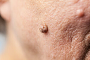 Stielwarzen selbst entfernen: Warum Experten dringend davon abraten ...